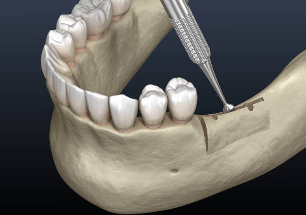 Understanding Ridge Augmentation: What It Is and Why You Might Need It